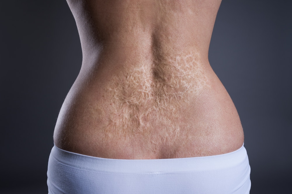 Burn Scars Therapy Burn Scars Therapy