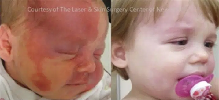 PDL | Pulsed Dye Lasers for Cosmetic Procedures
